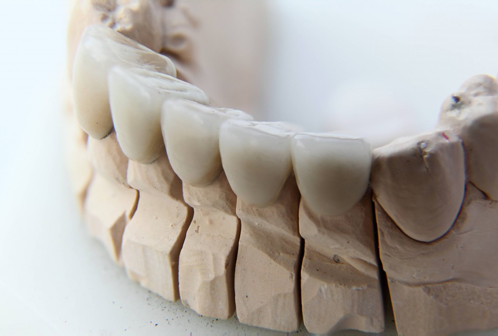 VMK-Krone_Dental_crown_Focus_stacking_with_freeware_CombineZP_15 ...